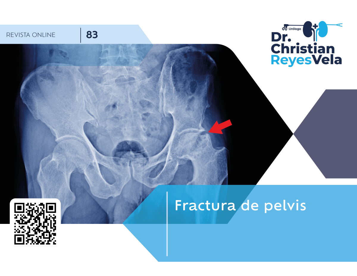 Fractura De Pelvis - Dr Christian Reyes Vela